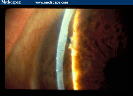 Primary Angle-Closure Glaucoma