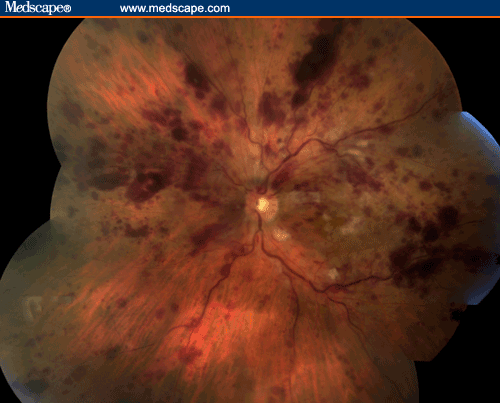 Central Retinal Vein Occlusion: Current Management Options