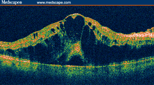 Central Retinal Vein Occlusion: Current Management Options