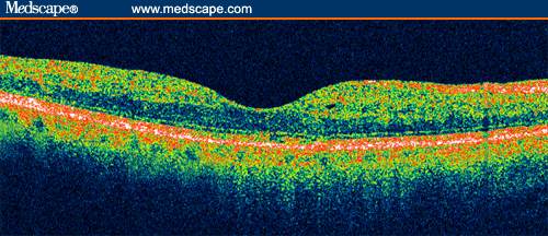 Central Retinal Vein Occlusion: Current Management Options