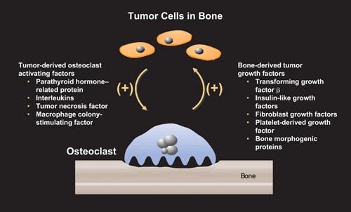 Skeletal Complications Across the Cancer Continuum: Bone Metastases and ...