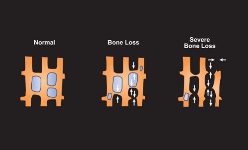 Skeletal Complications Across the Cancer Continuum: Bone Metastases and ...
