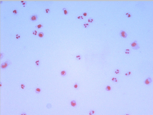 Pulmonary Tuberculosis With TB Meningitis