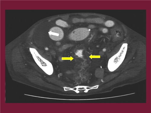 C difficile Infection in Primary Care-Tackling Virulent Pathogen-Transcript