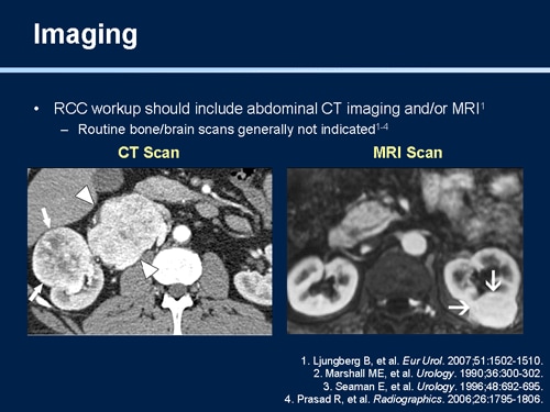 New Paradigms for Management of Unresectable/Recurrent RCC-Slide/Transcript