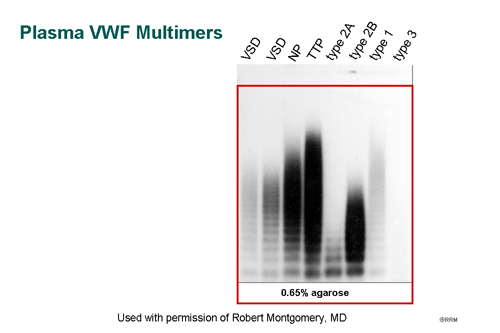 von Willebrand Disease-Pharmacist Role to Better Patient Outcome-Transcript