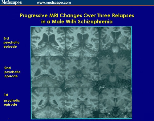 The Diagnosis and Treatment of Schizophrenia in Primary Care