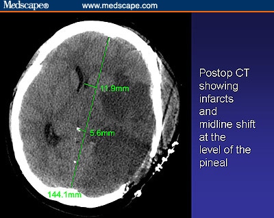 New Approaches to Treatment of Head Trauma and Stroke