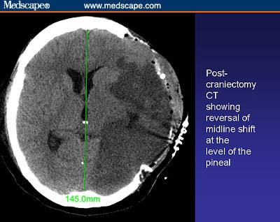 New Approaches to Treatment of Head Trauma and Stroke