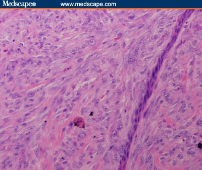 Less Common Cutaneous Malignancies