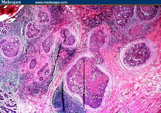 Ductal Carcinoma in Situ: Evolving Strategies to Optimal Diagnosis and ...
