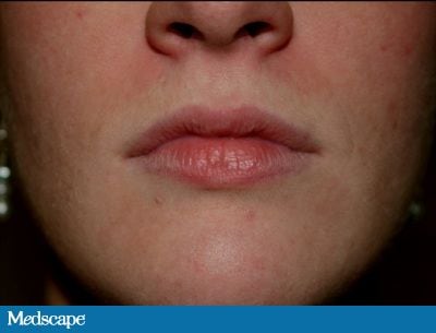 A 25-Year-Old Woman Seeking Subtle Lip Enhancement