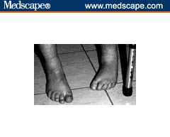 Spasticity: A Clinical Review
