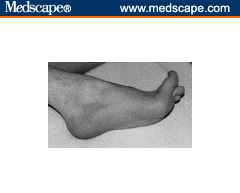 Spasticity: A Clinical Review