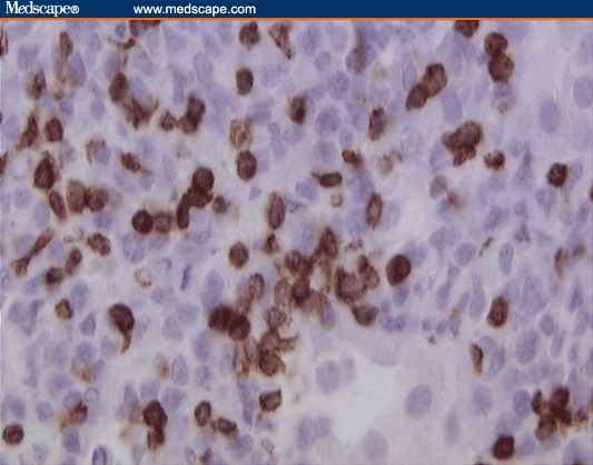 A Case of Acute Renal Failure With an Enlarged Graft 8 Years After ...