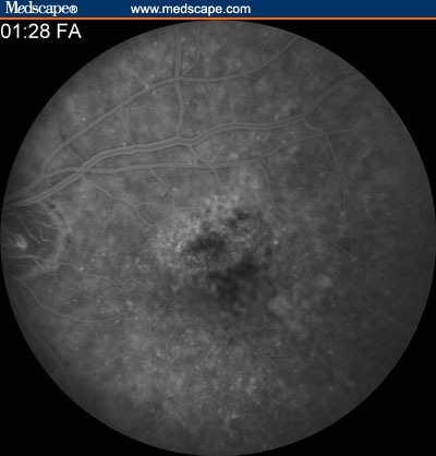 Expert Column - Diagnostic Techniques for Age-Related Macular Degeneration