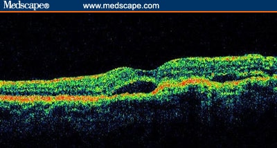 Expert Column - Diagnostic Techniques for Age-Related Macular Degeneration