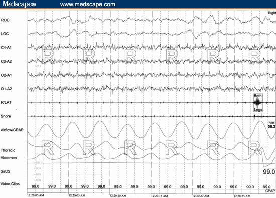 College Student With Excessive Sleepiness