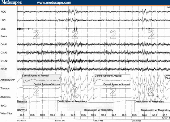 CSA With Daytime Fatigue and Sleepiness