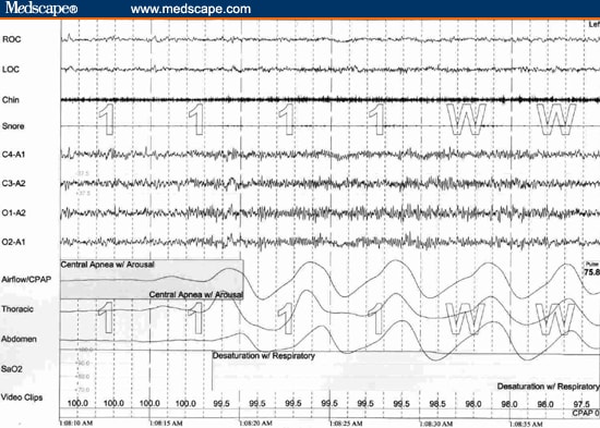 CSA With Daytime Fatigue and Sleepiness