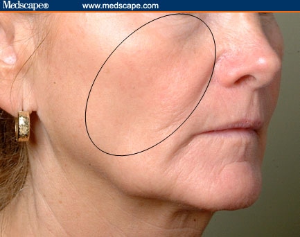 Facial Contouring and Volumization