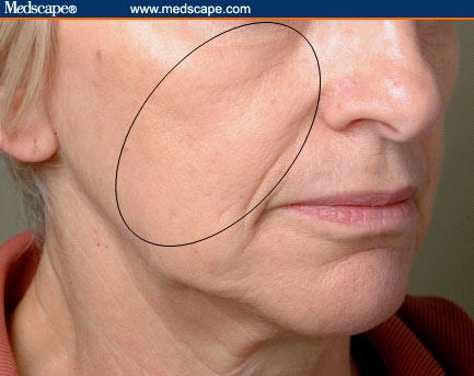 Facial Contouring and Volumization