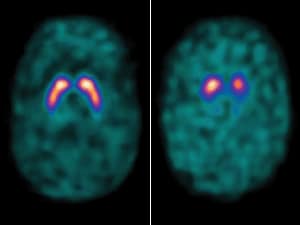 FDA Approves DaTscan for Imaging of Dopamine Transporters
