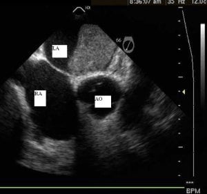 Septal Pouch in the Left Atrium Debated as a Source of Stroke