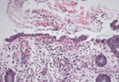 Dificid (fidaxomicin) dosing, indications, interactions, adverse ...