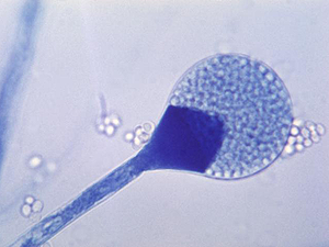 Fungal Skin Infections Skyrocket After Missouri Tornado