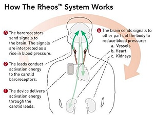 Rheos Device Equivocal in Resistant Hypertension