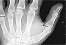 Stener Lesion: Practice Essentials, Anatomy, Pathophysiology