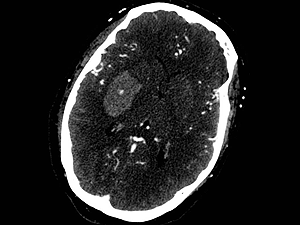 Spot Sign on CT Suggests Intracerebral Hematoma Expansion