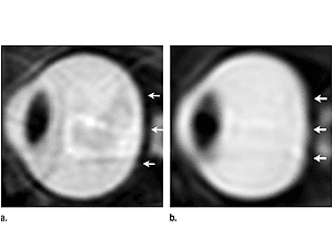 MRI Explores Mystery of Ocular Pathology After Space Flight