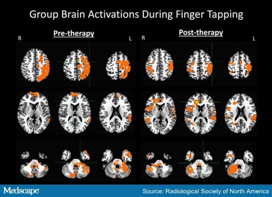 Brain Therapy Helps Rehabilitate Stroke Patients