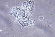 Balanitis Guidelines: Guidelines Summary