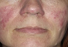 Mirvaso (brimonidine topical) dosing, indications, interactions ...