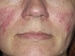 FDA Clears Ivermectin Cream (Soolantra) for Rosacea
