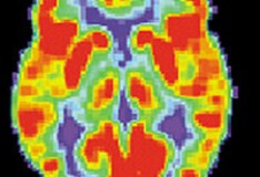 Neuraceq (florbetaben F 18) dosing, indications, interactions, adverse ...
