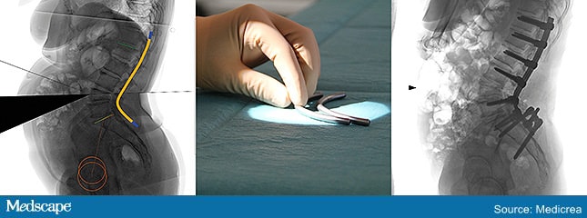 FDA Approves First Customized Spinal Rod