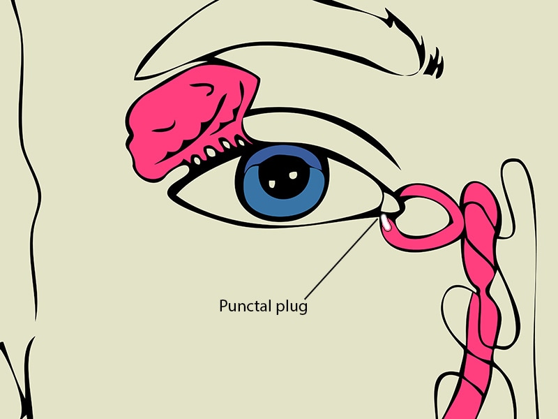 American Academy of Ophthalmology (AAO) 2014 Annual Meeting
