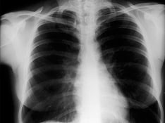 Seebri Neohaler, Lonhala Magnair (glycopyrrolate inhaled) dosing ...