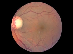 Simbrinza (brinzolamide/brimonidine) dosing, indications, interactions ...