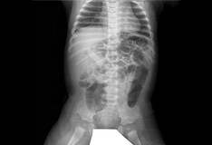 Imaging in Child Intussusception: Overview, Radiography, Computed ...