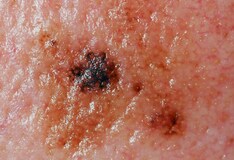 gmcsf, Leukine (sargramostim) dosing, indications, interactions ...