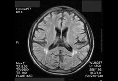 Betaseron, Extavia (interferon beta 1b) dosing, indications ...