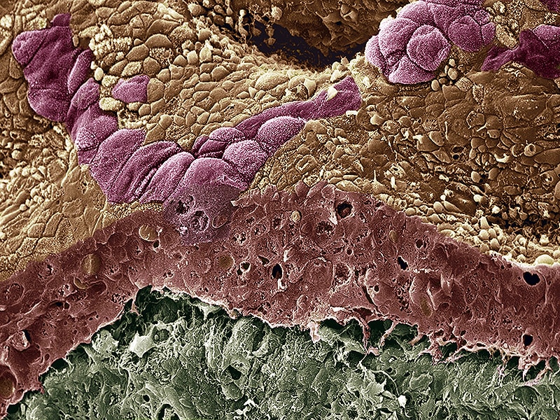 Special Report: FDA Advisory Panel Supports Morcellation Restrictions