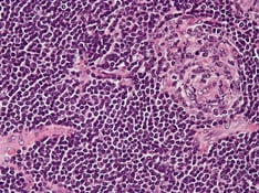 Sylvant (siltuximab) dosing, indications, interactions, adverse effects ...