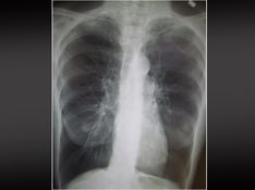 Yupelri (revefenacin) dosing, indications, interactions, adverse ...