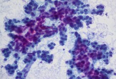 Lipiodol (ethiodized oil) dosing, indications, interactions, adverse ...